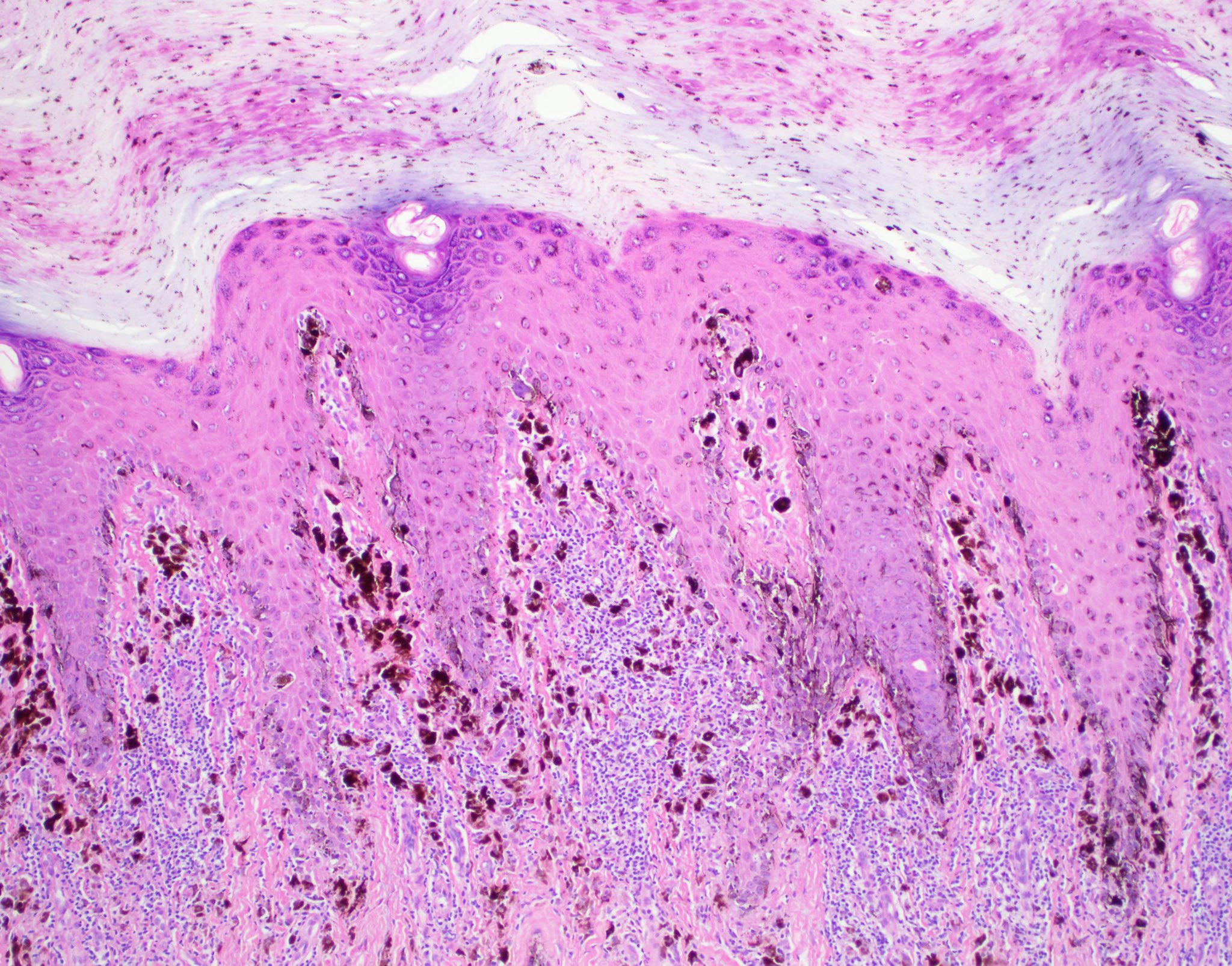 Acral Lentiginous Melanoma Histology
