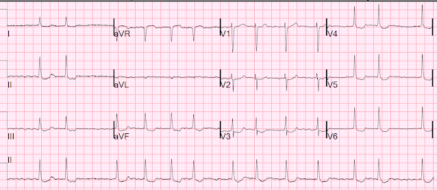 Digitalis Ecg