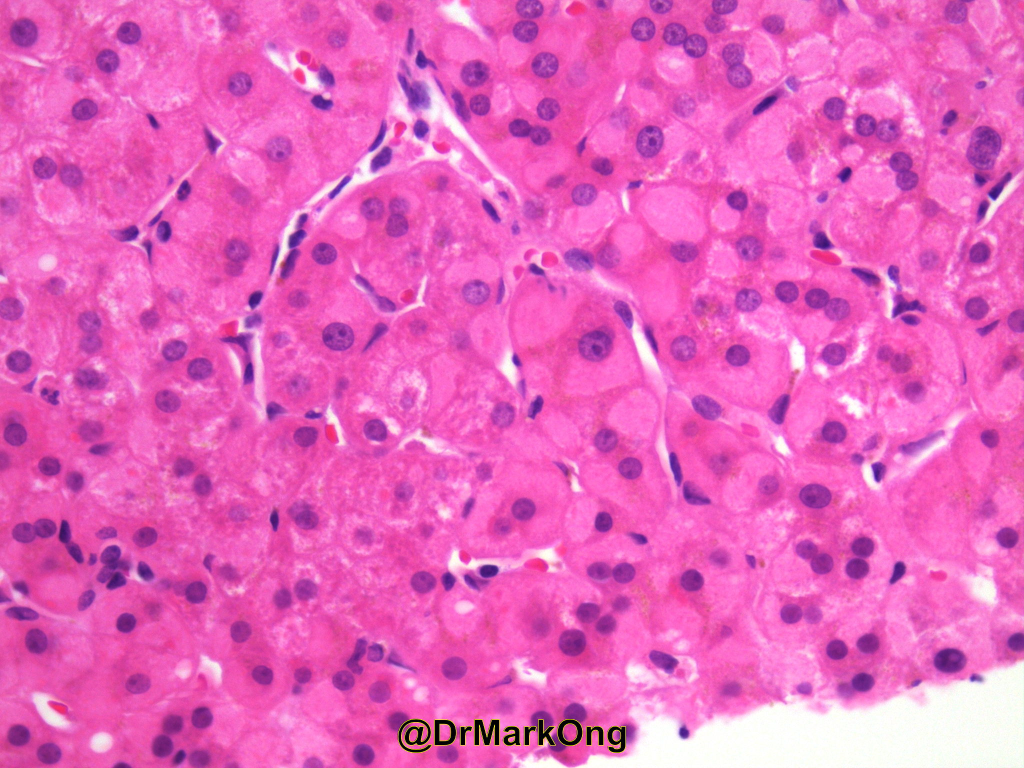 Hepatitis B Ground Glass Hepatocytes