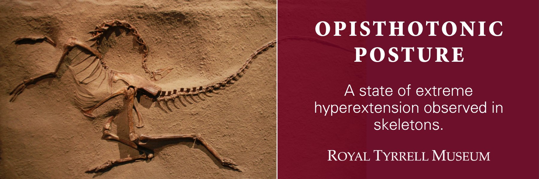 Opisthotonic Posturing