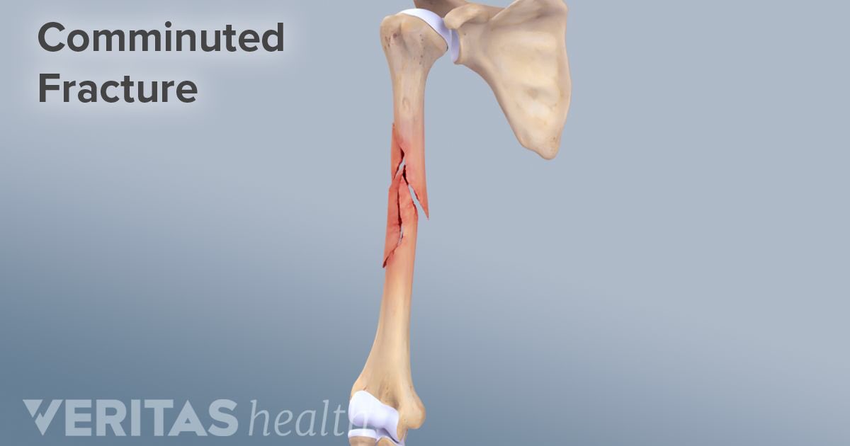 Comminuted Fracture
