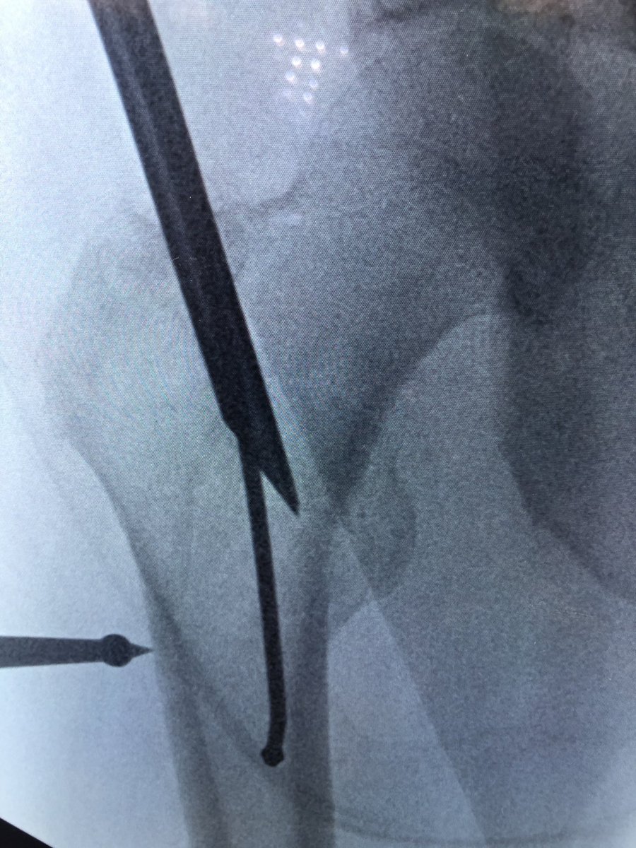 [1/5] These pertrochanteric fractures can be tricky if greater troch ...