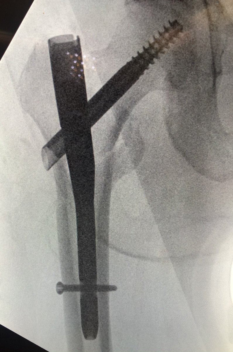 [1/5] These pertrochanteric fractures can be tricky if greater troch ...