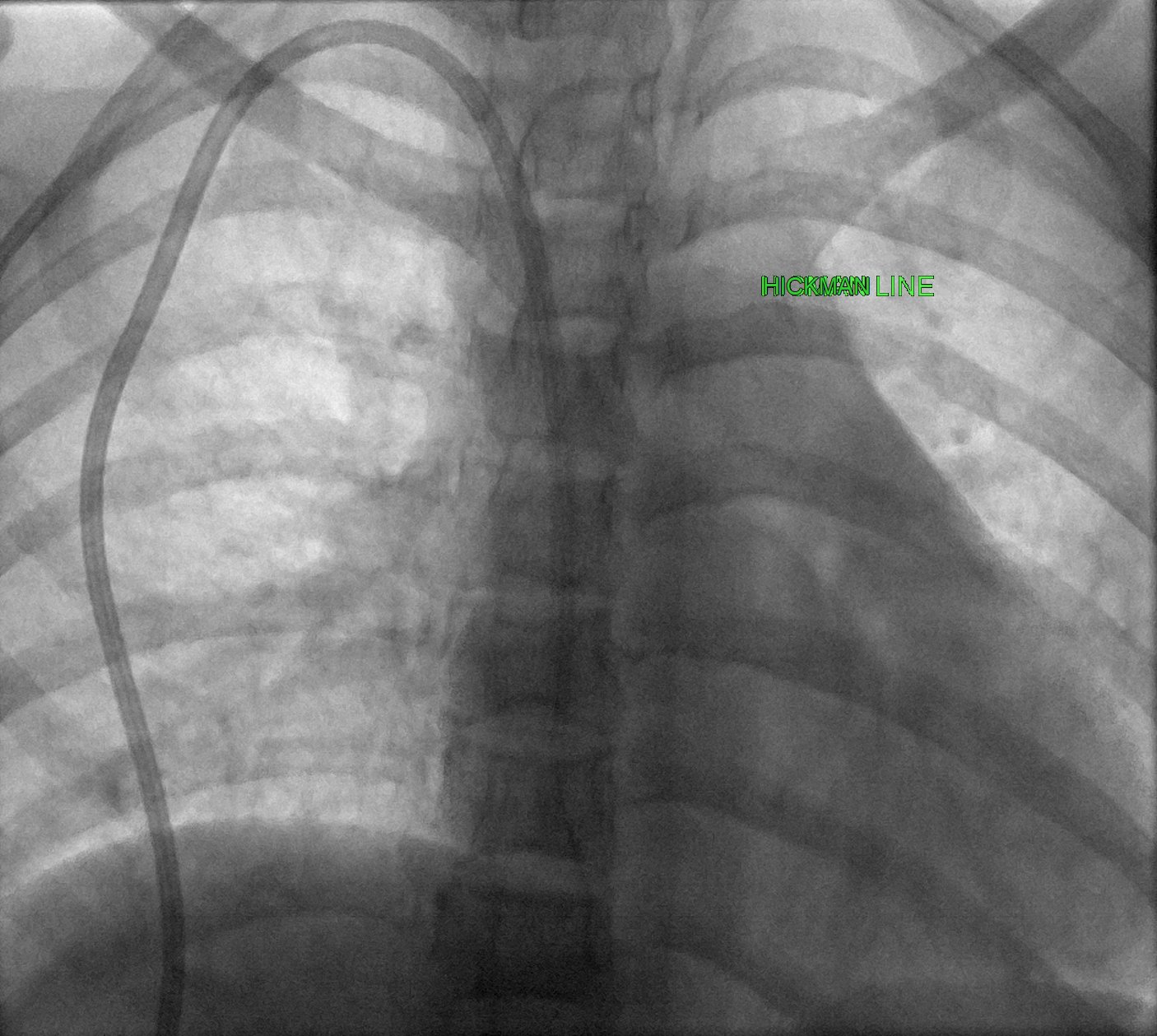 Hickman Catheter X Ray