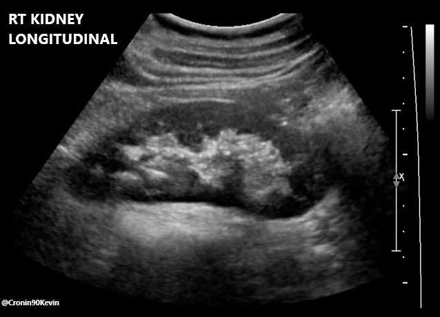 Normal Kidney Ultrasound