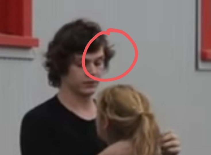 Emma Roberts Bruises