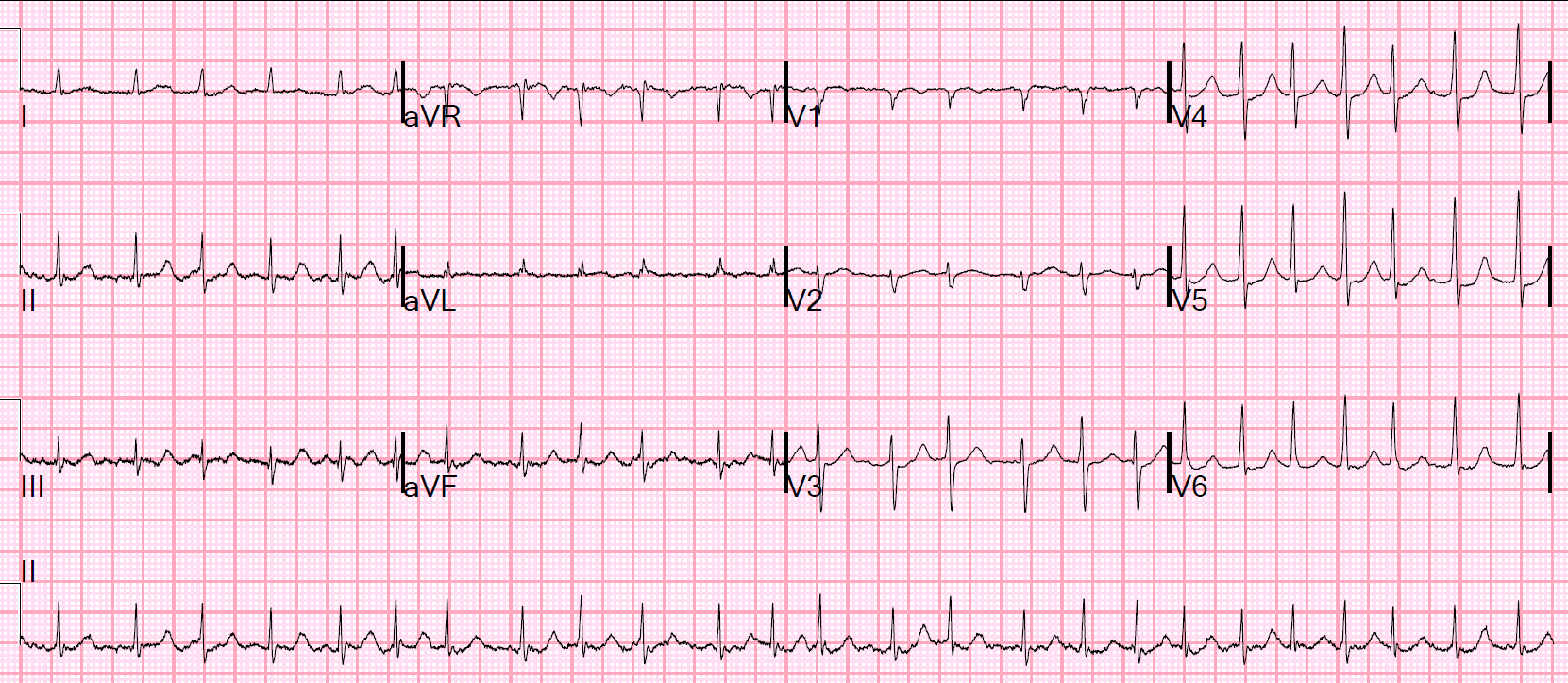 Atrial Fibrillation With Rvr