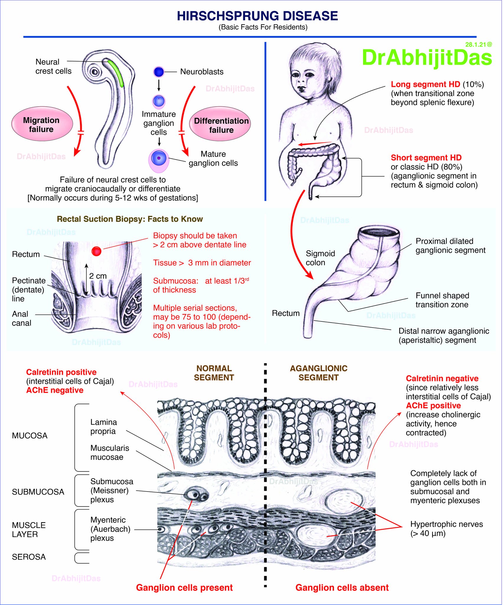 Hirschsprungs Disease