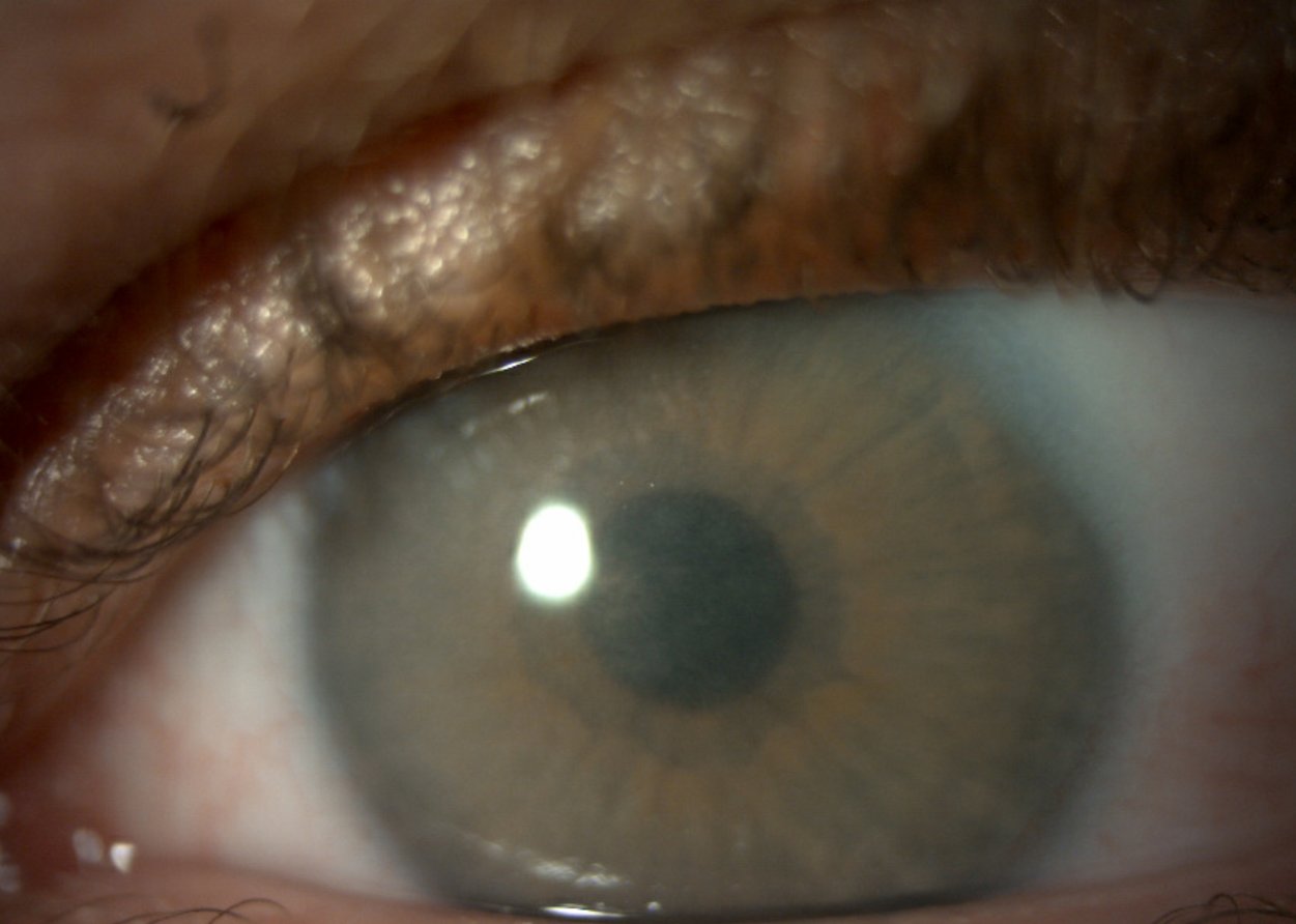 Hurler Syndrome Corneal Clouding