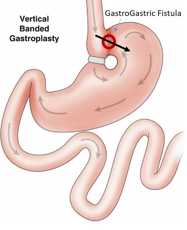 Vertical Banded Gastroplasty