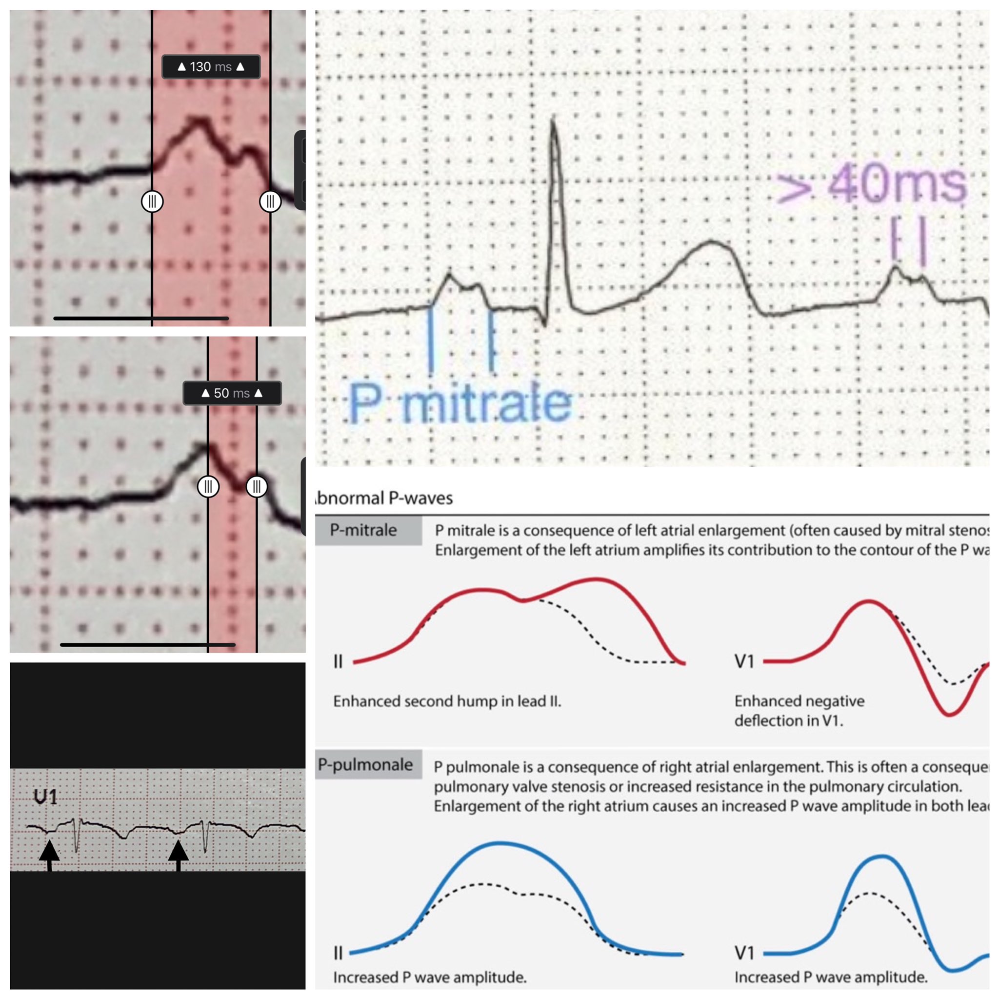 P Mitral Left: The Anatomical Reciprocal Position Of The Aortic,