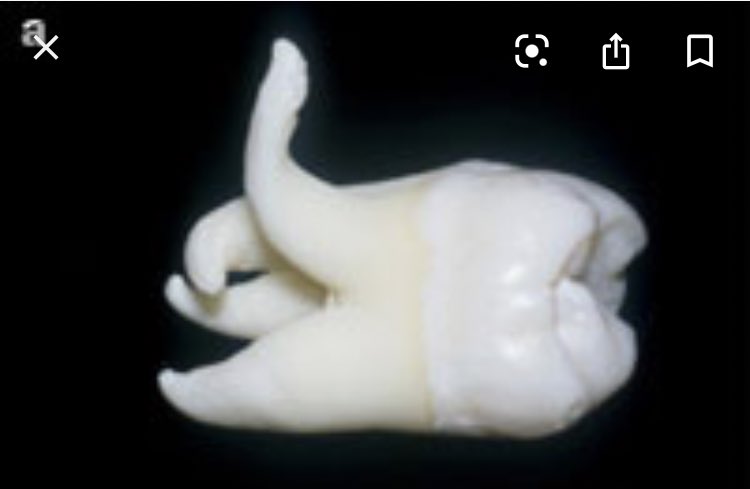 Wisdom Teeth Roots Curved