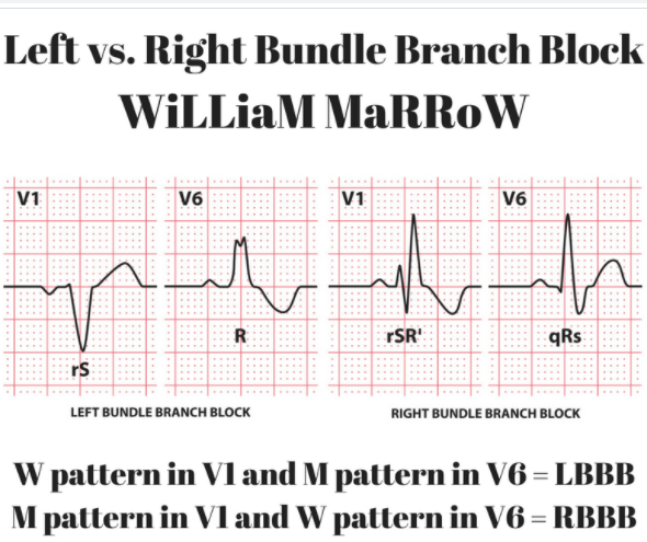 Left Bundle Branch Block Ecg Left Bundle Branch Block Ecg
