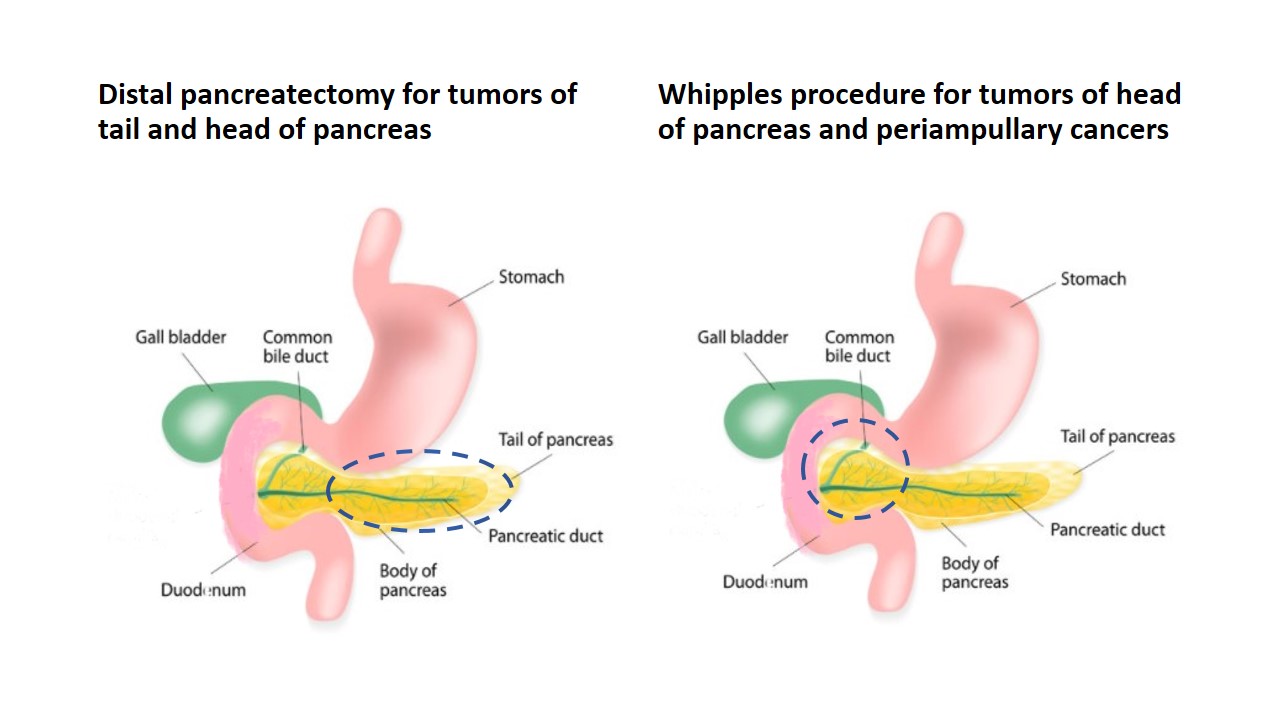 Distal Pancreatectomy