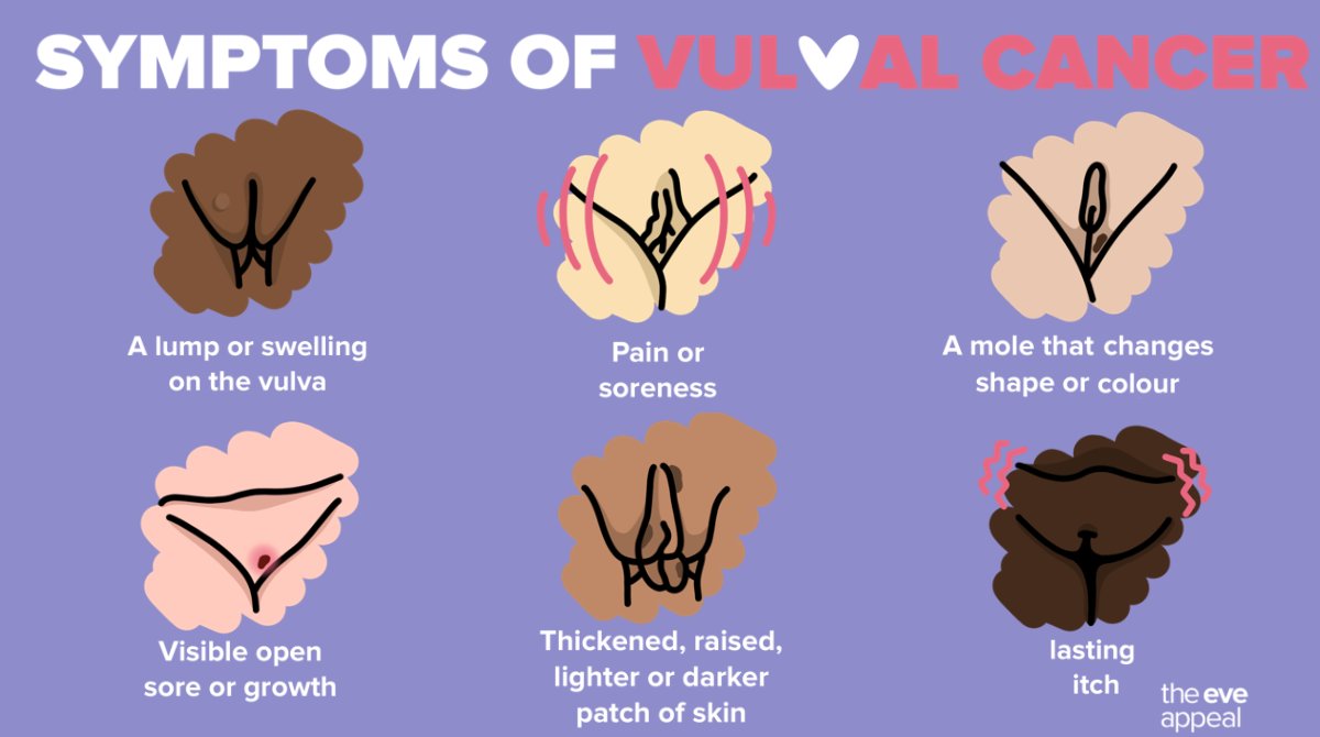 Vulvar Intraepithelial Neoplasia Symptoms