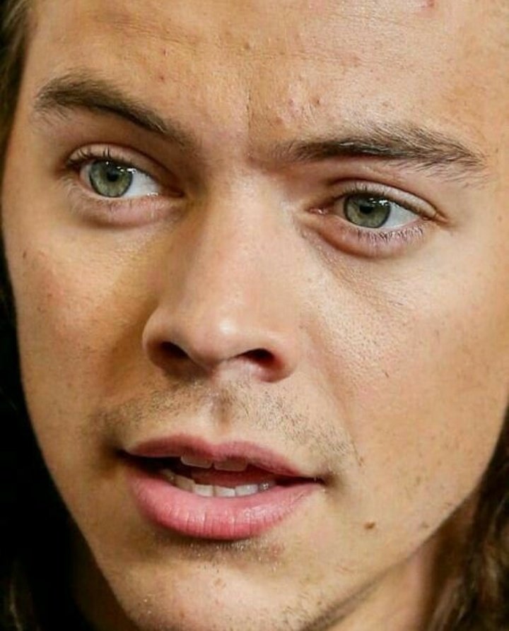 Harry One Direction Acne