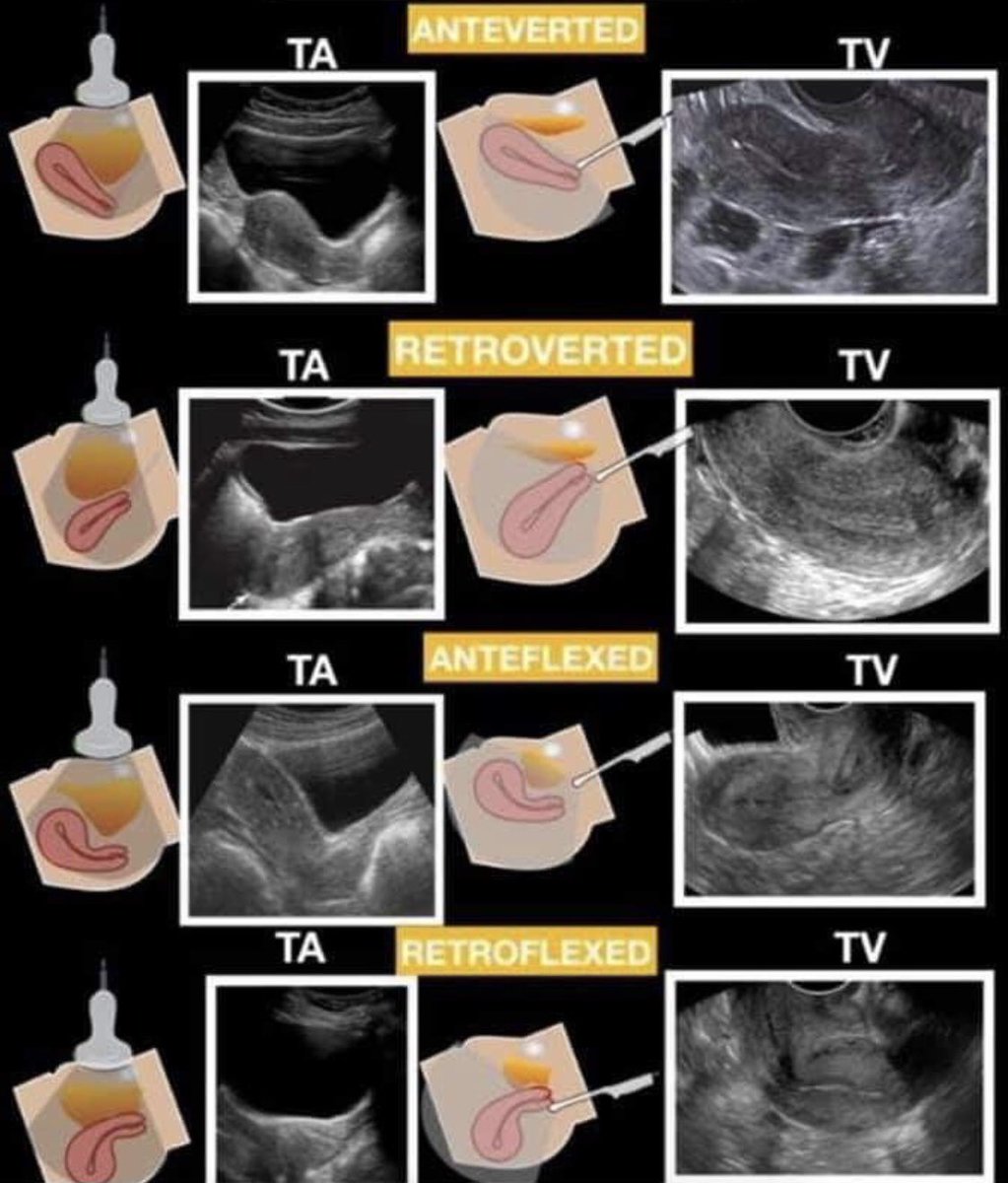 Anteverted Uterus Ultrasound Anteverted Uterus Ultrasound