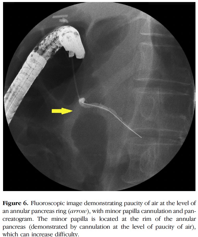 Annular Pancreas Ercp