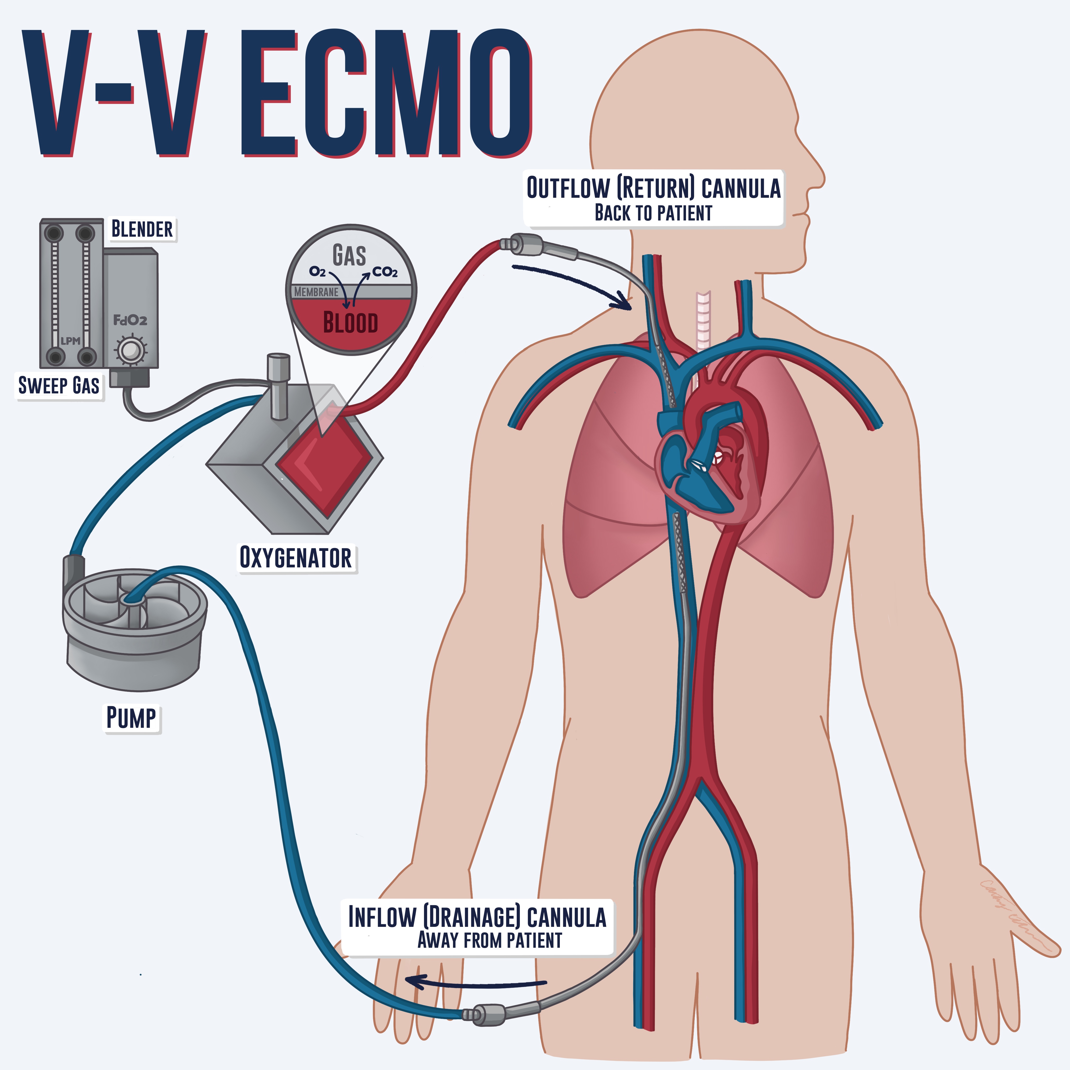Vv Ecmo
