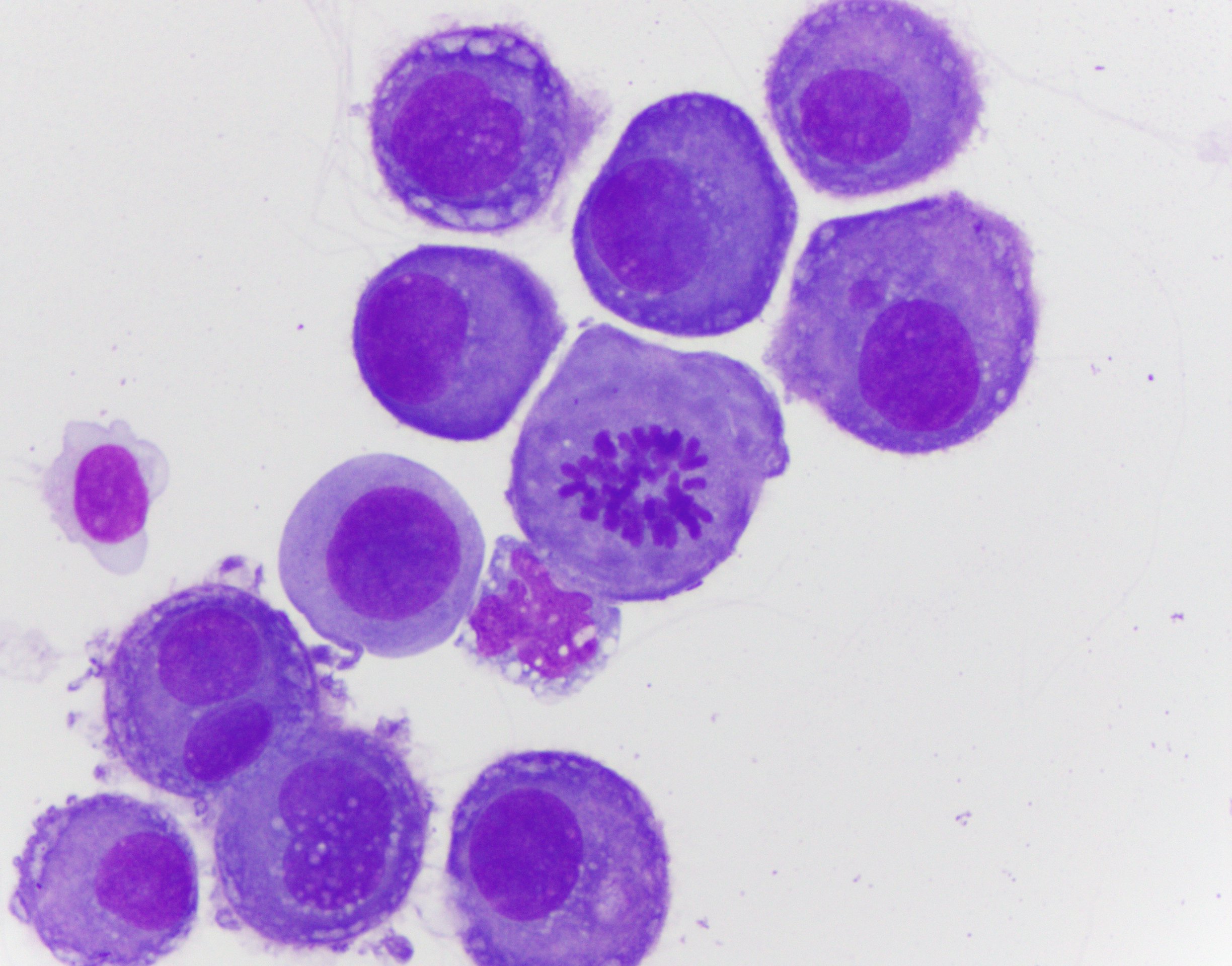 Pleural Fluid Cells Images Pleural Fluid Cells Images