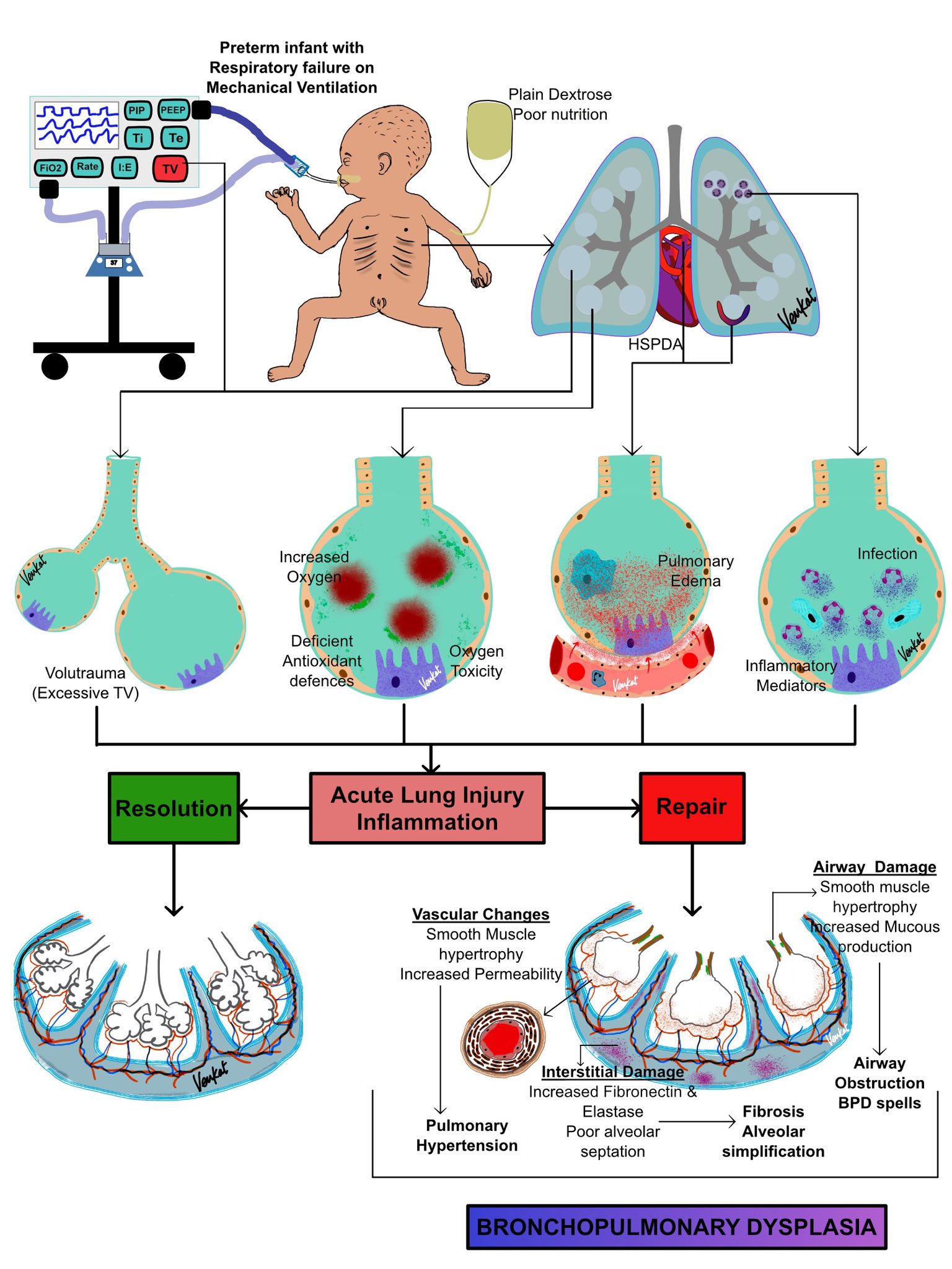 Bronchopulmonary Dysplasia Pathophysiology