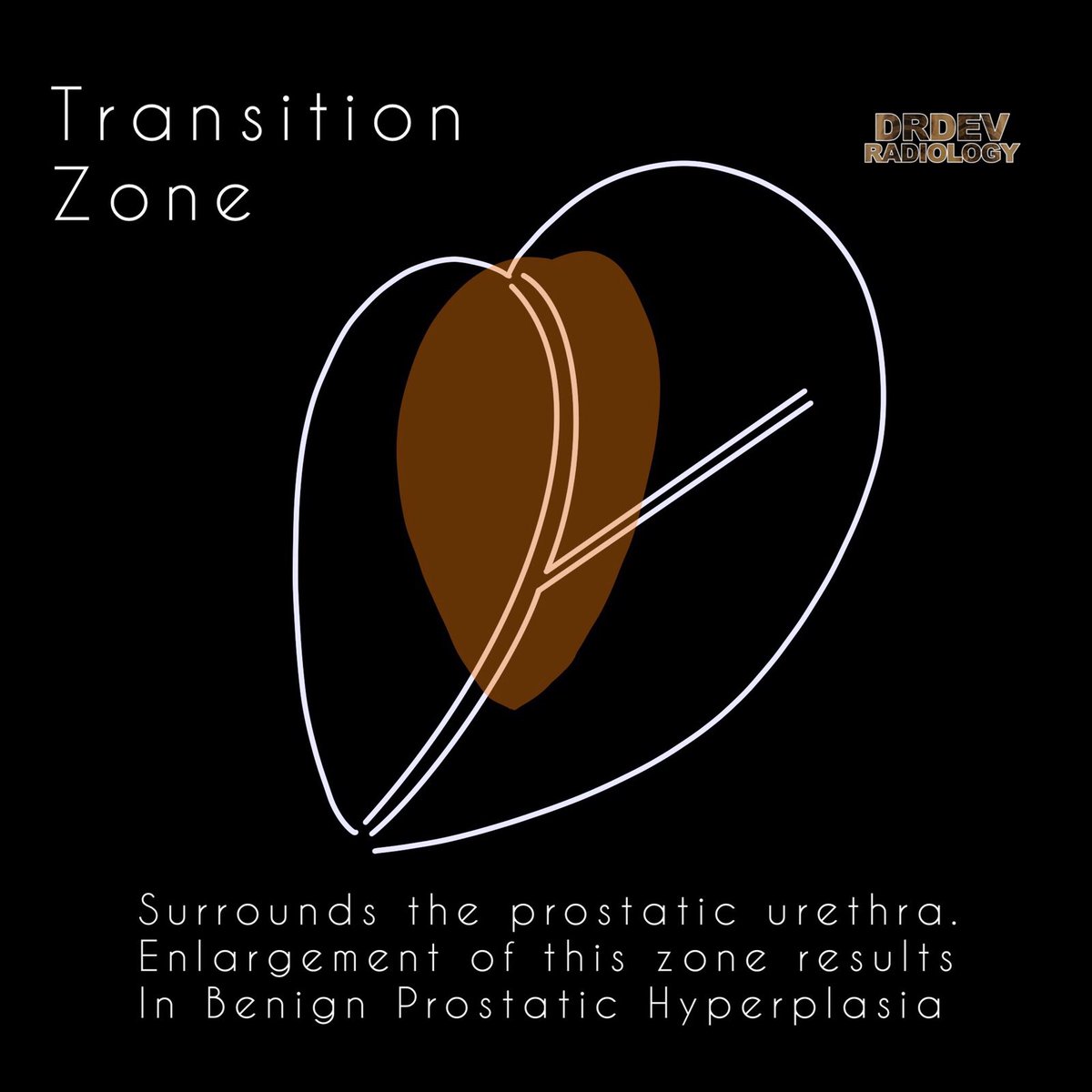 Illustration of the zonal anatomy of the prostate https://t.co ...