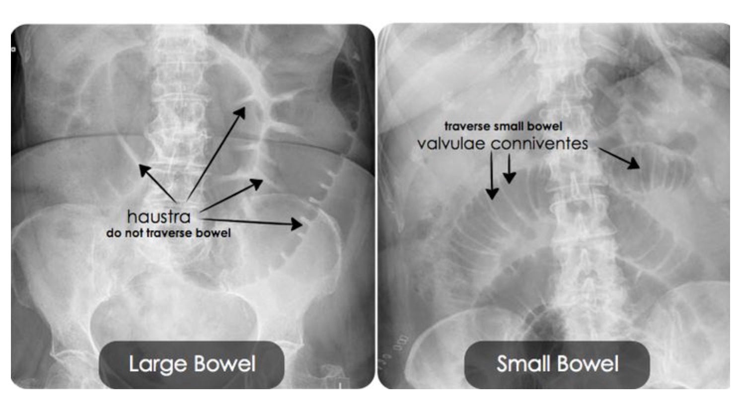 Bowel Obstruction X Ray