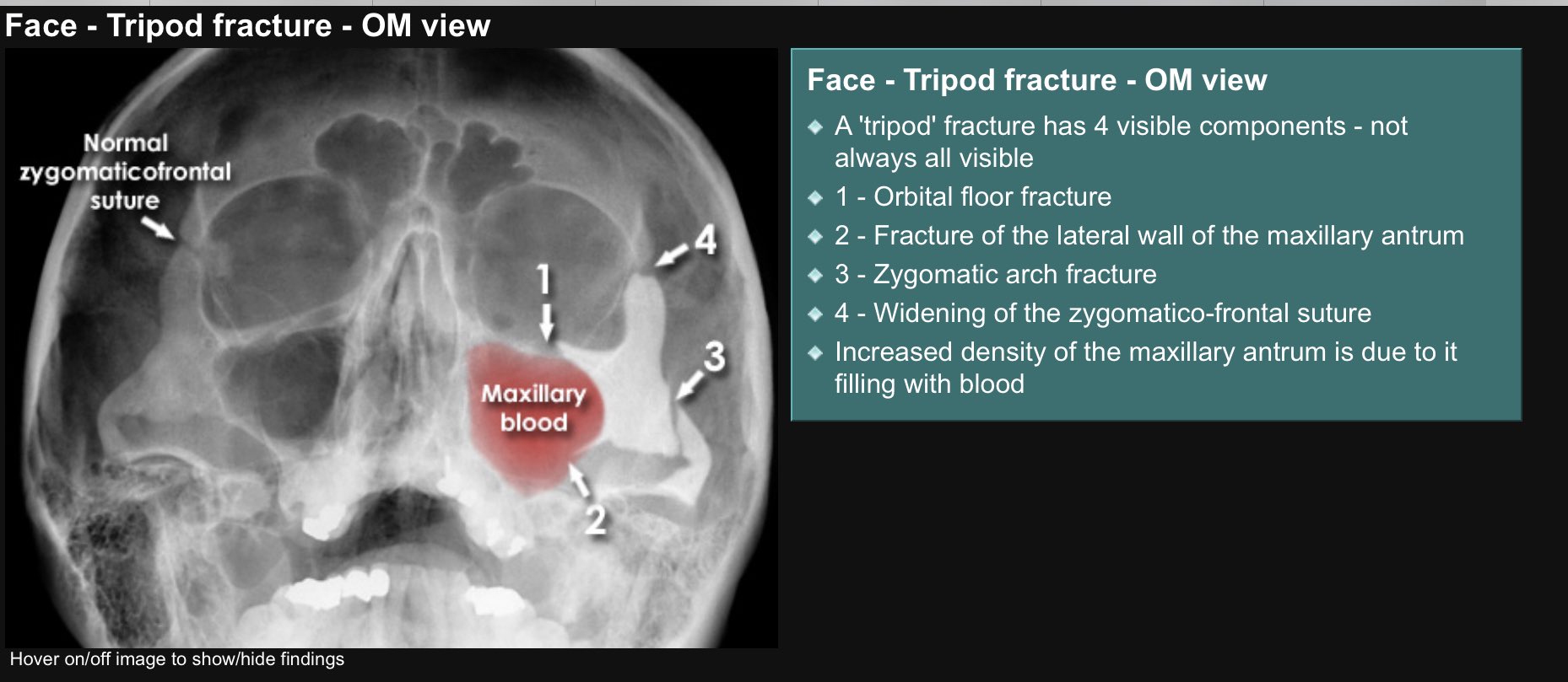 Zygomaticofrontal Suture