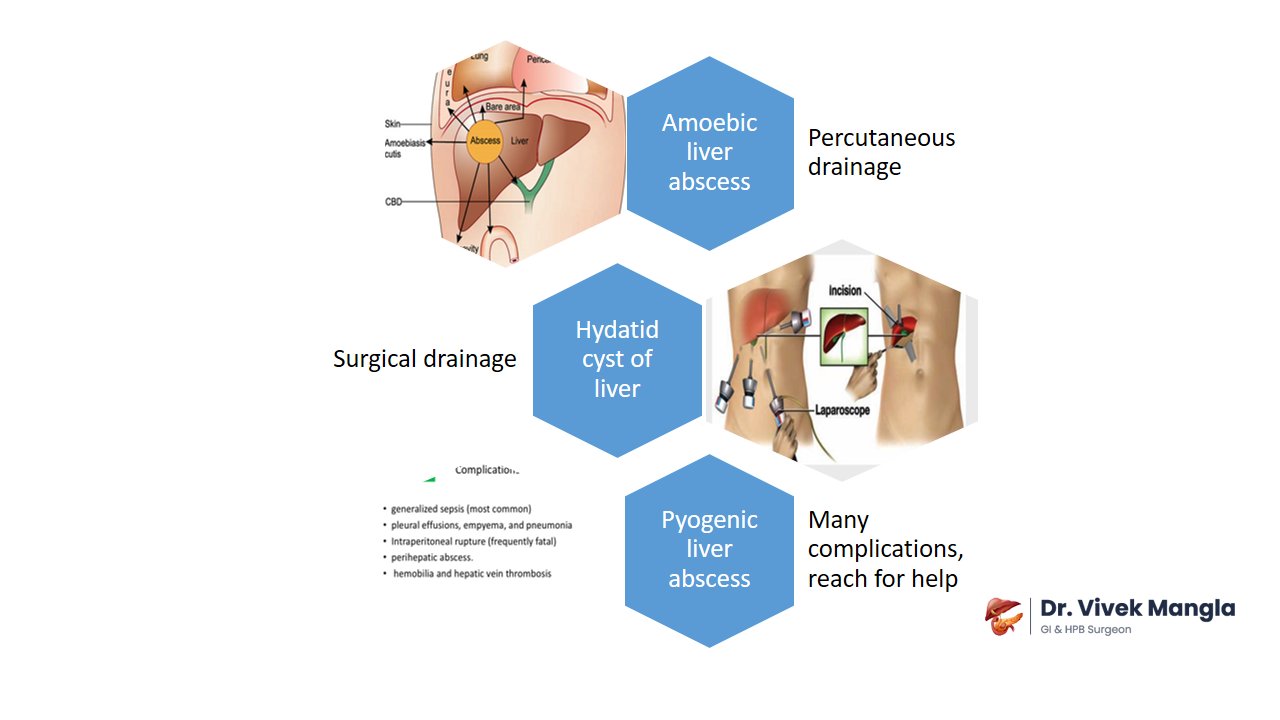 Liver Abscess Surgery
