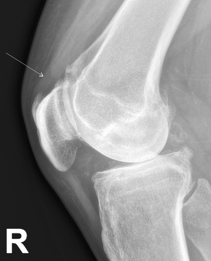 Quadriceps Tendon Calcification