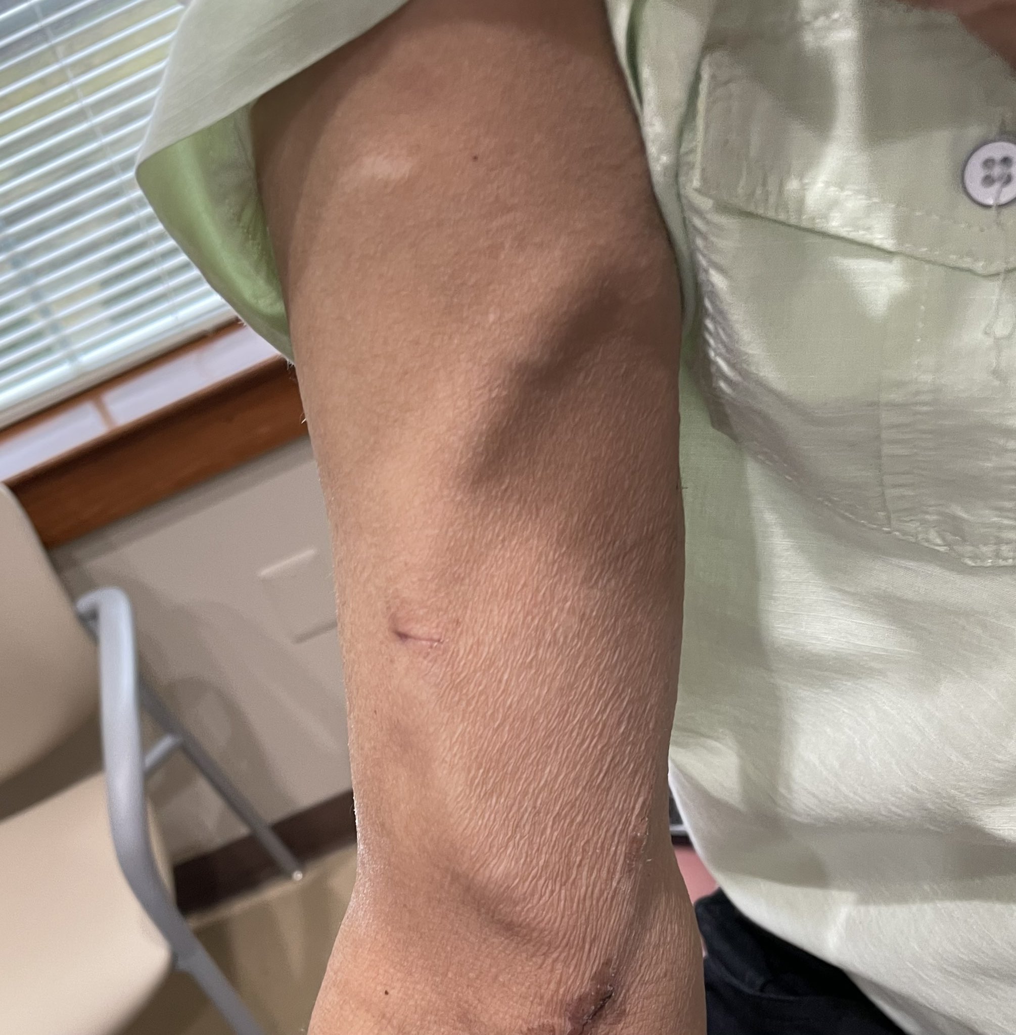 Brachiobasilic Fistula