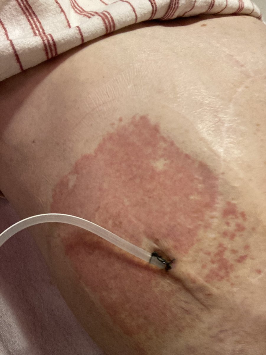 Dave Stukus On X: Rashes From Bandaids Are Very Common, 44% OFF