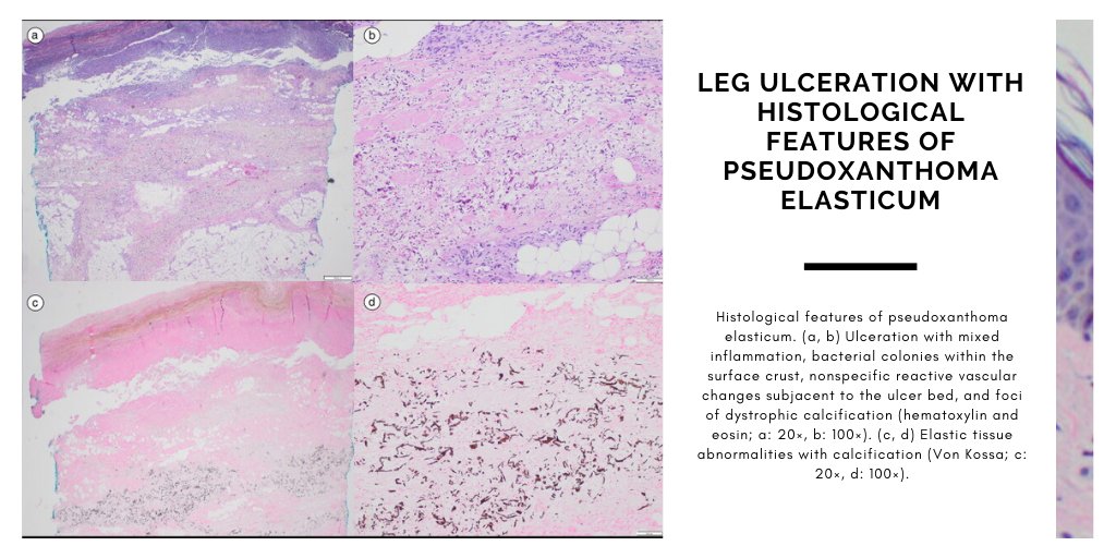 Pseudoxanthoma Elasticum Histology