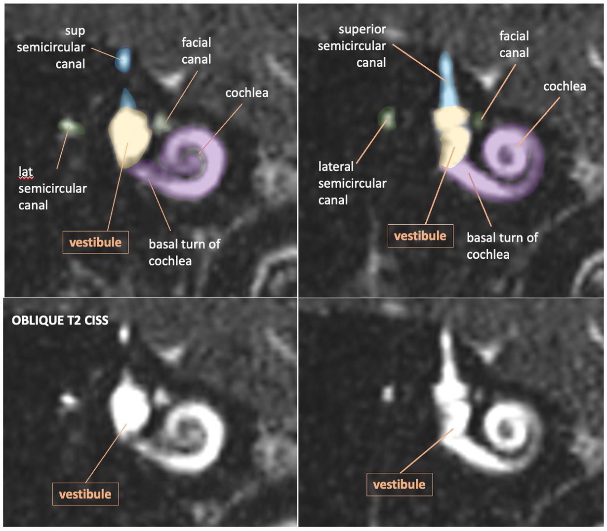 Utricle And Saccule