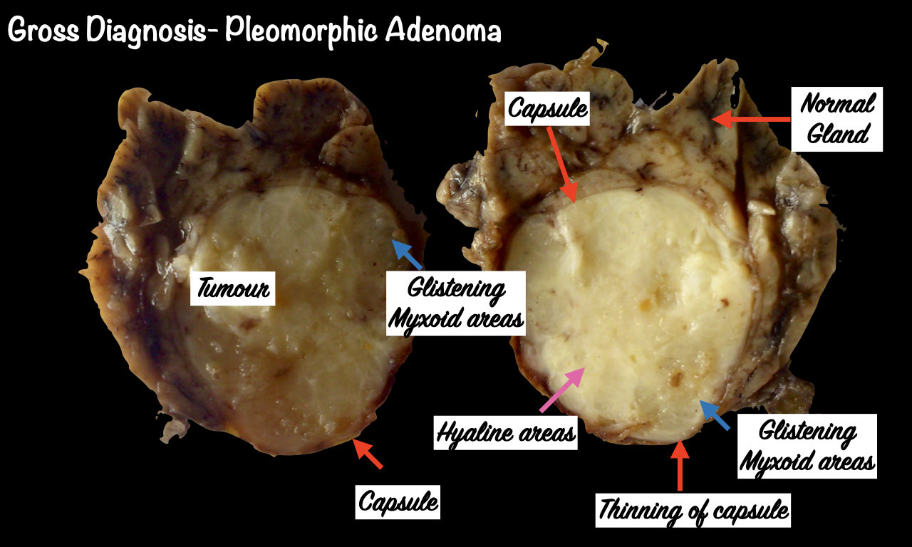 Pleomorphic Adenoma Gross