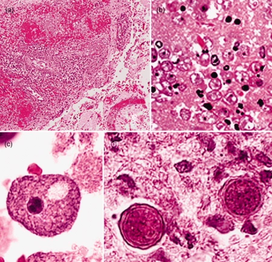 Weekend Digest H&E of brain biopsy of a 79 man with encephalitis. Name ...