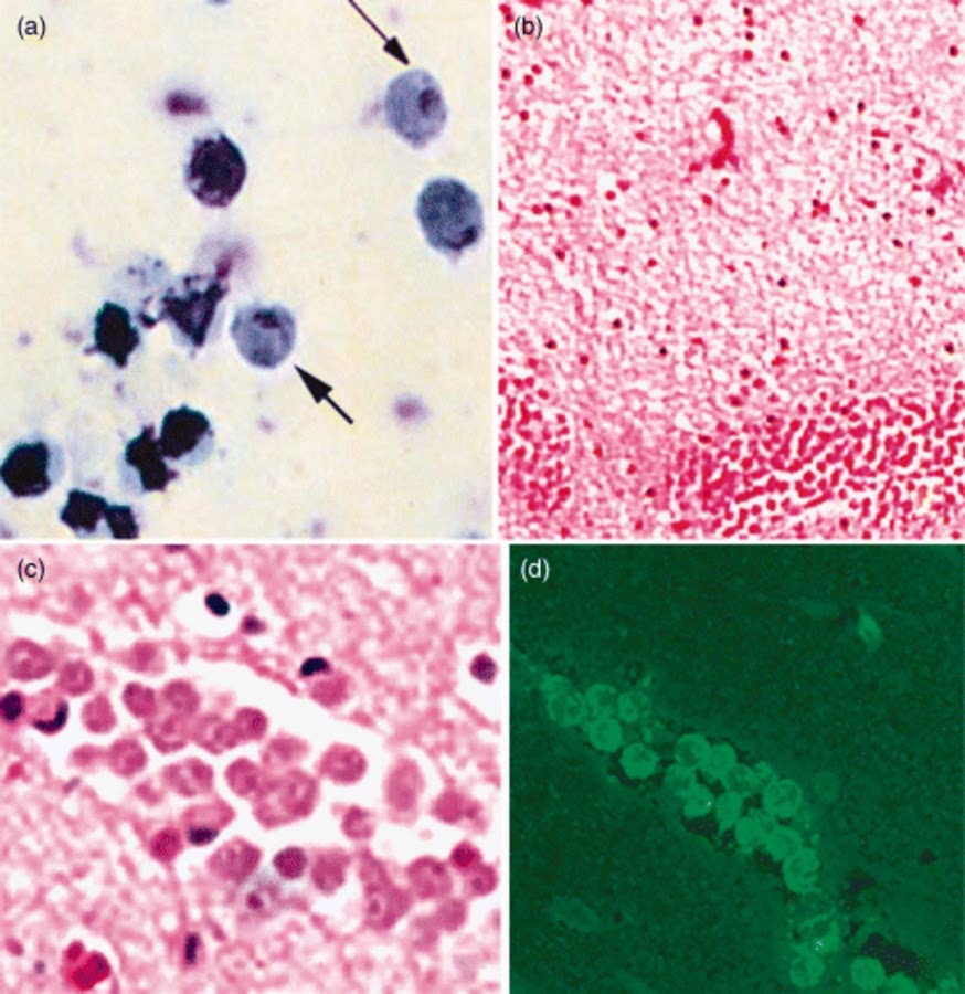 Weekend Digest H&E of brain biopsy of a 79 man with encephalitis. Name ...