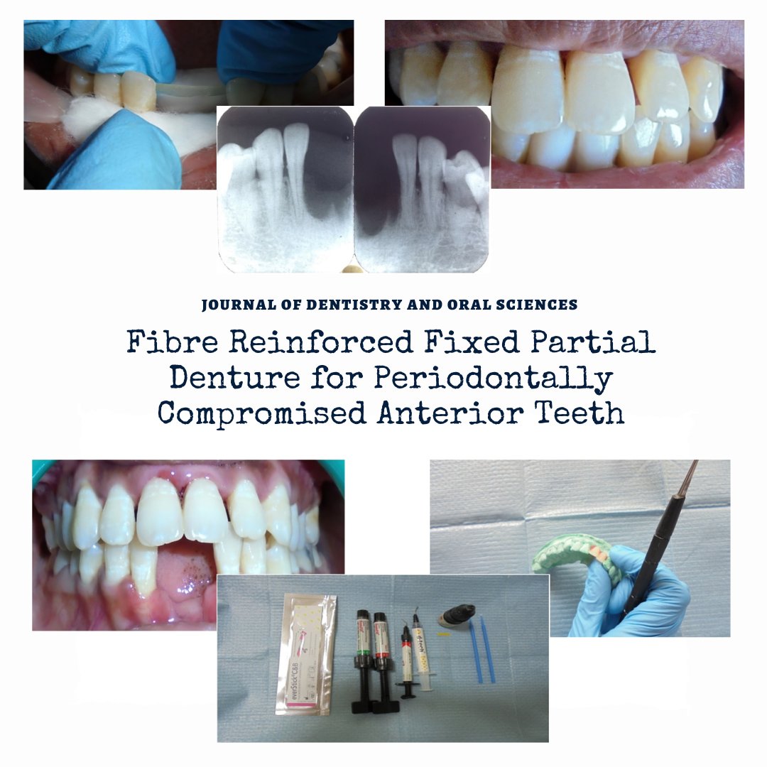 Anterior Fixed Partial Denture
