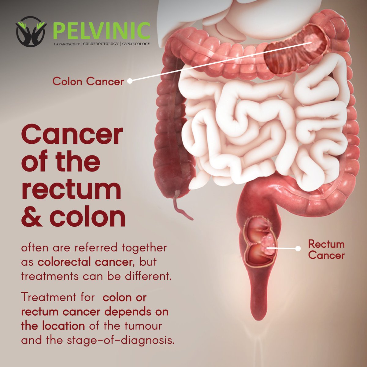 Bloody Stool Colon Cancer