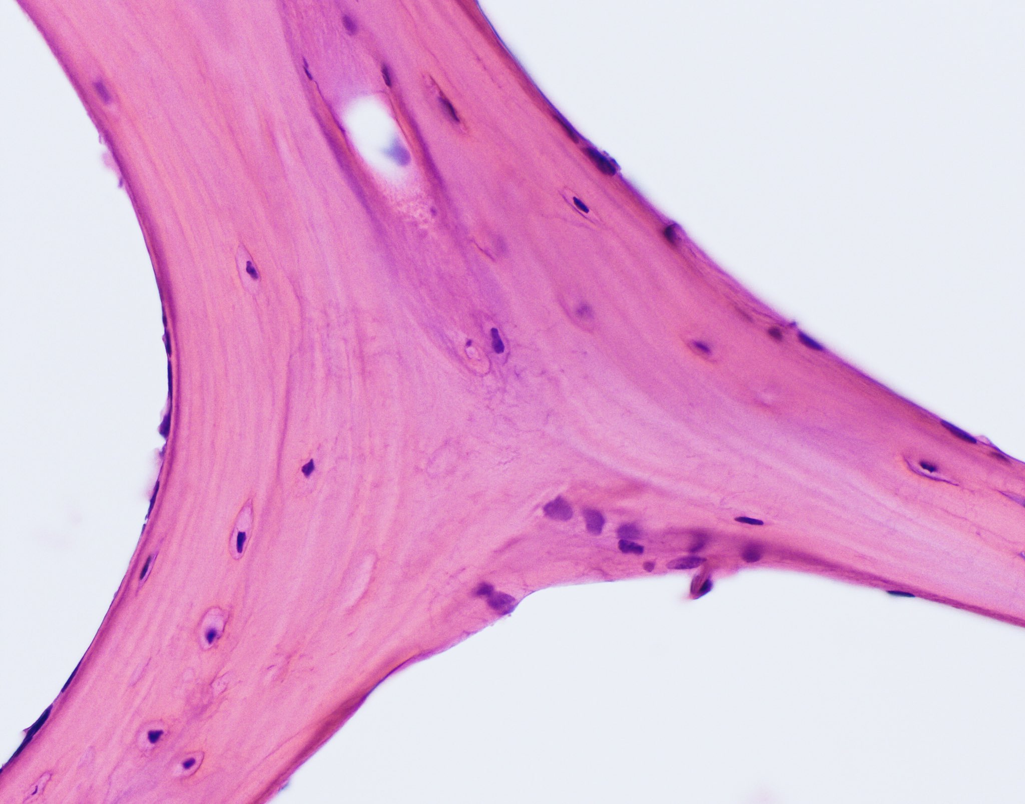 Osteosarcoma Histology Labeled