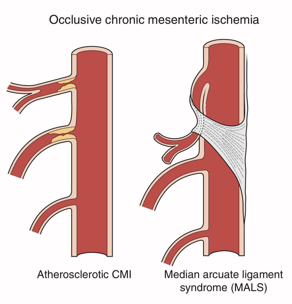 Arcuate Ligament Syndrome