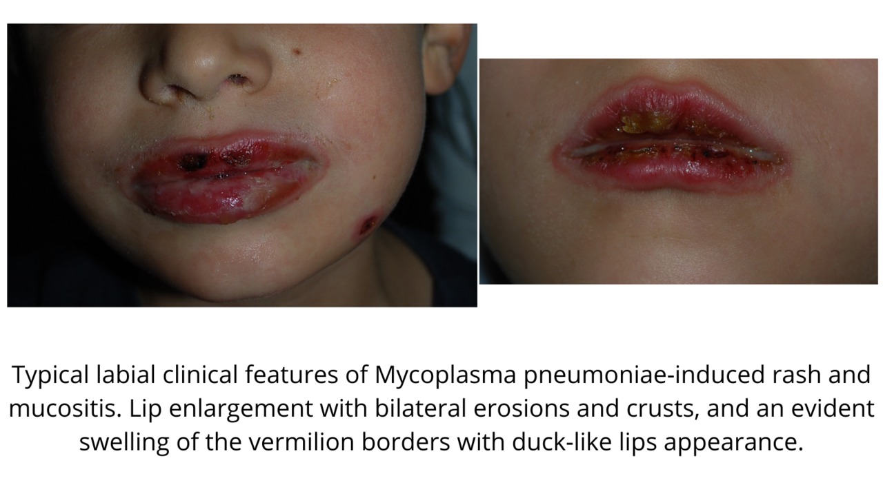 Mycoplasma Rash