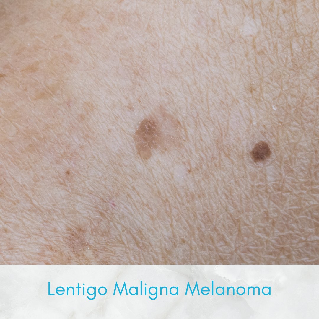 Lentigo Maligna Melanoma