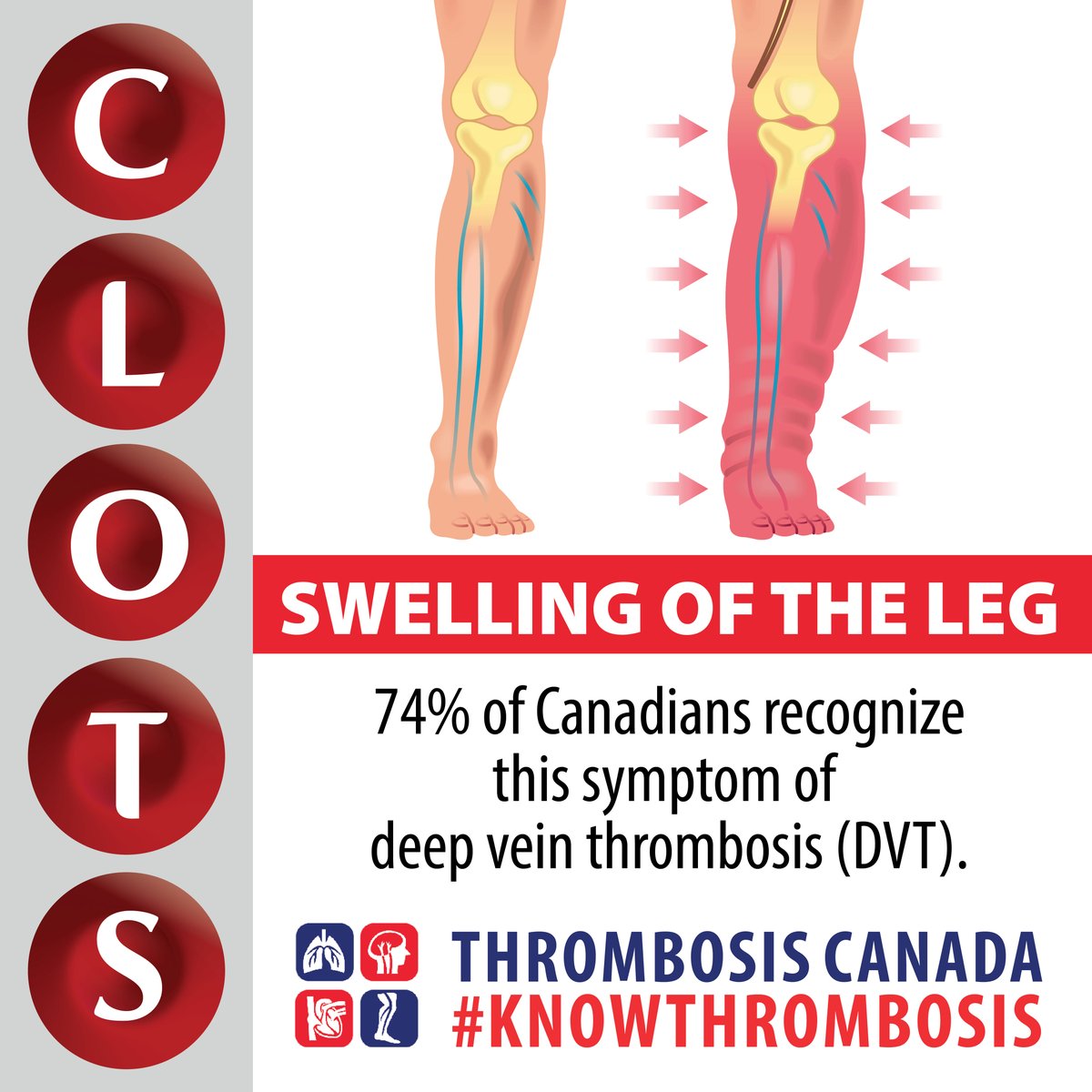 Clinical Guides | Thrombosis Canada – Thrombose Canada