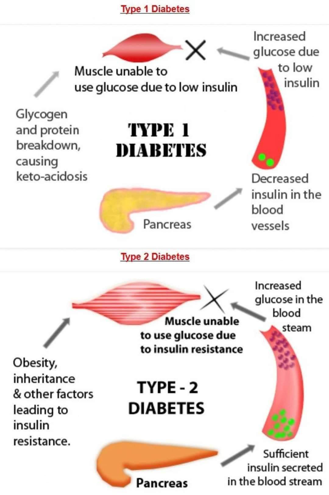 Pancreas Diabetes Diagram