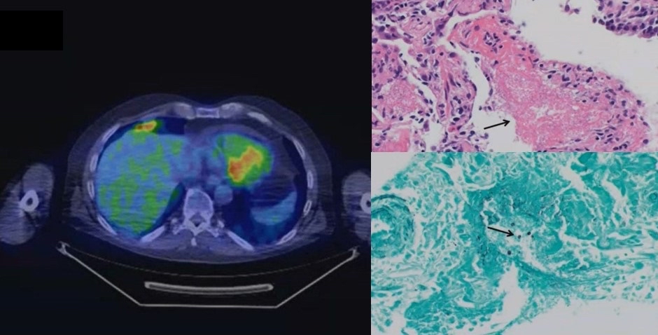 Images of Infectious Diseases 2m post PLEX, IVIG, steroids, rituximab ...