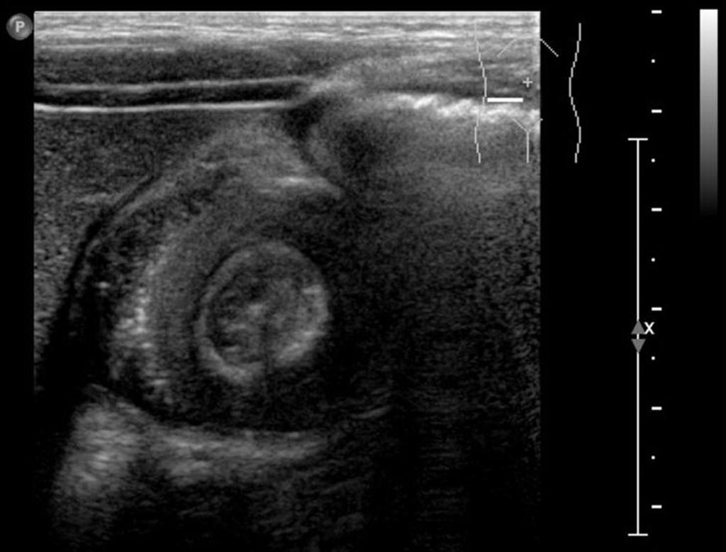 Intussusception Claw Sign