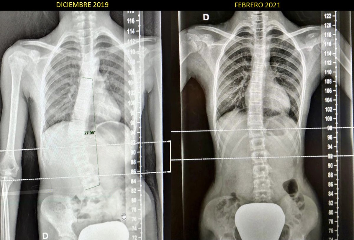 Corseparaescoliosisantesydespues