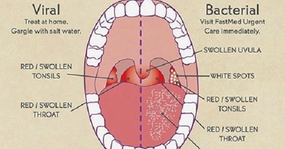 Pharyngitis Diagram