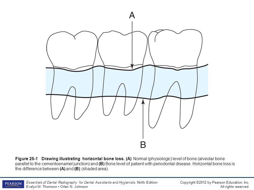 Alveolar Bone Loss